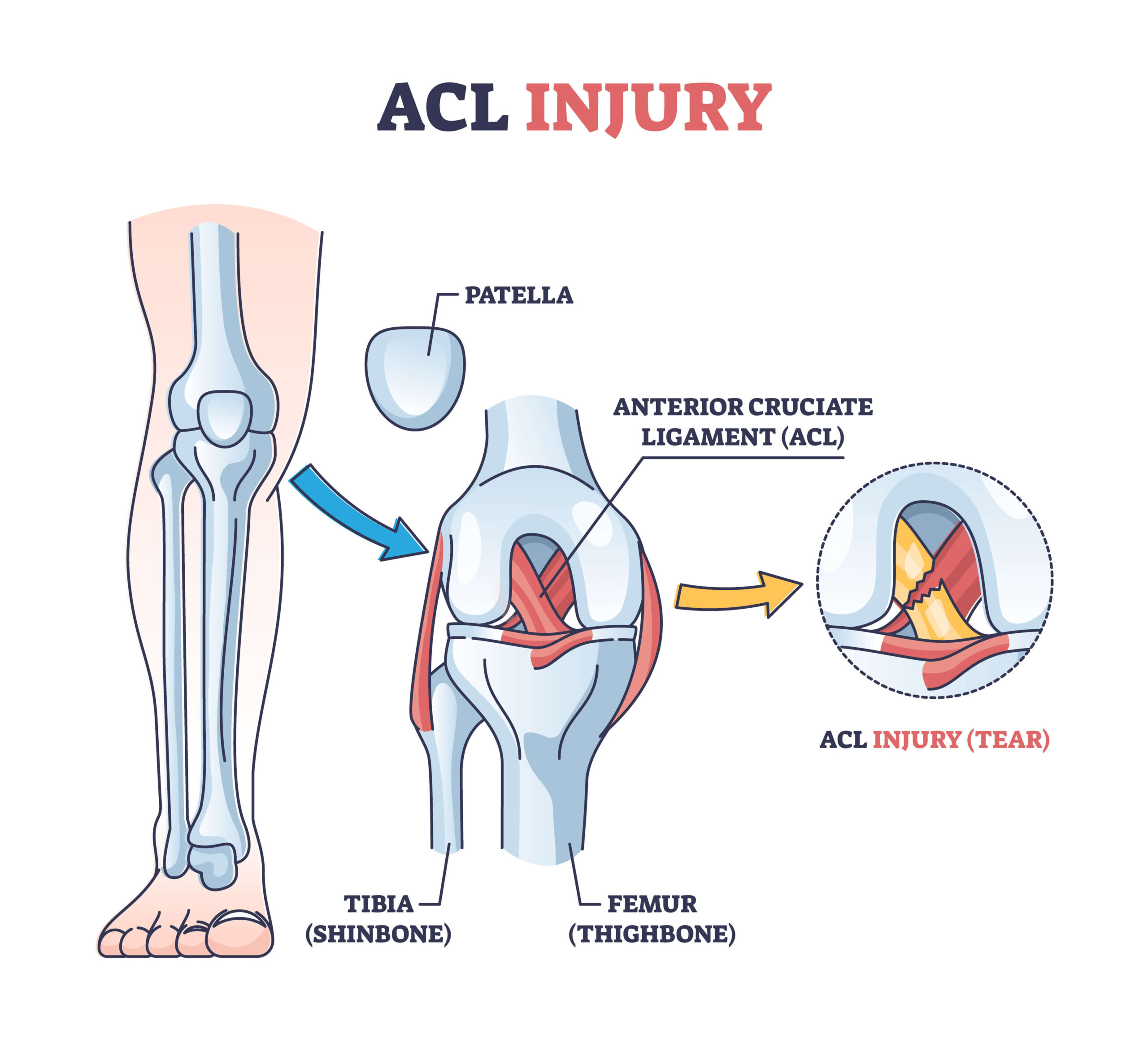 What Is An ACL Injury Symptoms Causes Treatments BCOS What Is An ACL Injury Symptoms Causes Treatments BCOS